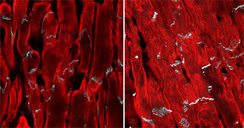 Could gene therapy treat a deadly heart condition that targets young ...