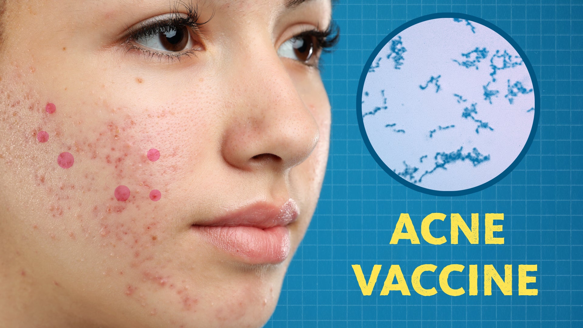 Why Do I Have Red Spots On My Face Not Acne Reddit Infoupdate Why Do I Have Red Spots On My Face Not Acne Reddit Infoupdate