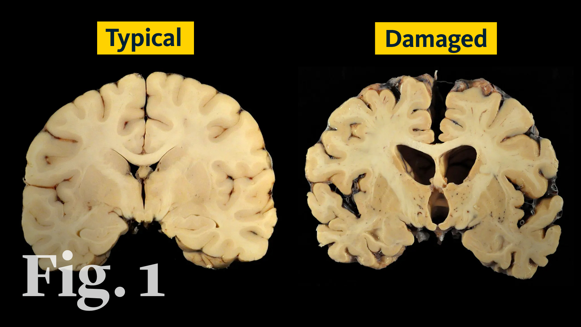 Why some concussions are worse than others | University of California